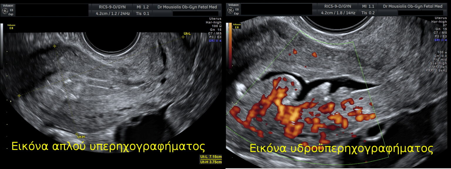 ΠΟΛΥΠΟΔΕΣ ΕΝΔΟΜΗΤΡΙΟΥ & ΤΡΑΧΗΛΟΥ: Η σημασία της έγκυρης διάγνωσης για ...