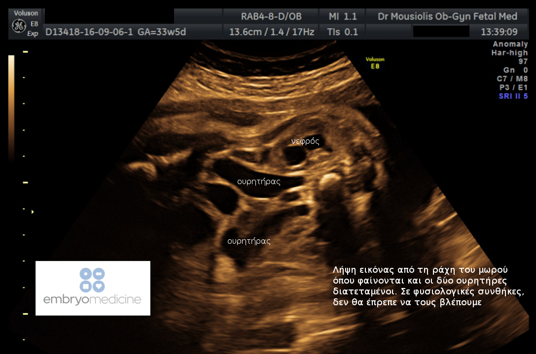 ΠΑΡΟΥΣΙΑΣΗ ΠΕΡΙΣΤΑΤΙΚΟΥ: ΠΡΟΓΕΝΝΗΤΙΚΗ ΔΙΑΓΝΩΣΗ ΑΝΩΜΑΛΙΑΣ ΤΟΥ ...