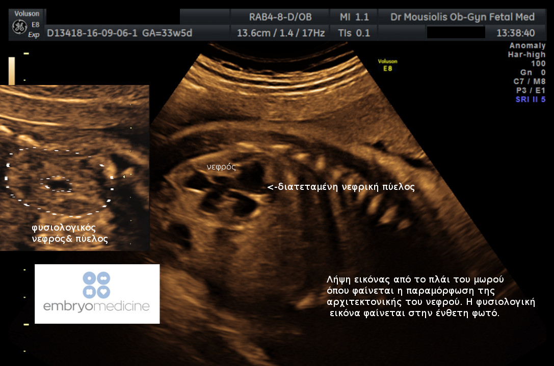 ΠΑΡΟΥΣΙΑΣΗ ΠΕΡΙΣΤΑΤΙΚΟΥ: ΠΡΟΓΕΝΝΗΤΙΚΗ ΔΙΑΓΝΩΣΗ ΑΝΩΜΑΛΙΑΣ ΤΟΥ ...